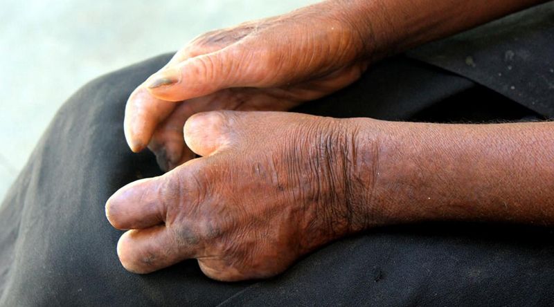 Lepra: Sensibilização das pessoas em procurar estruturas de saúde é o ...